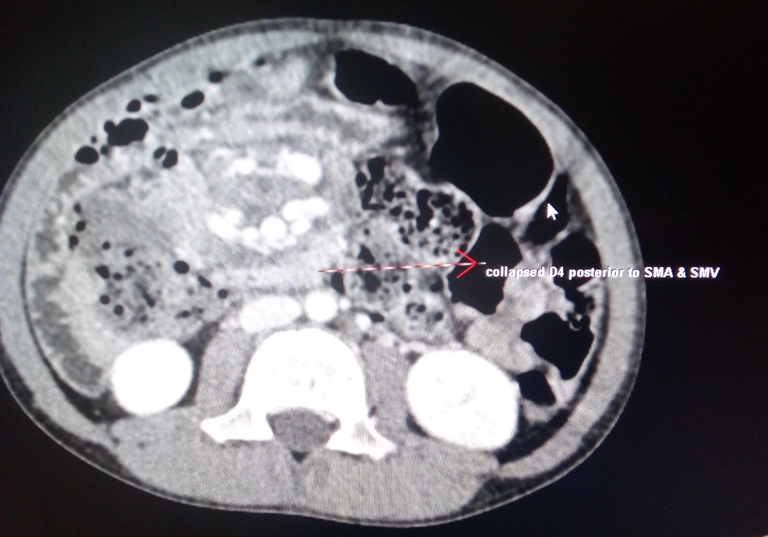 Midgut Volvulus CT - Sumer's Radiology Blog