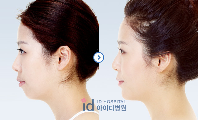 ID Hospital Korea: Small Chin Correction