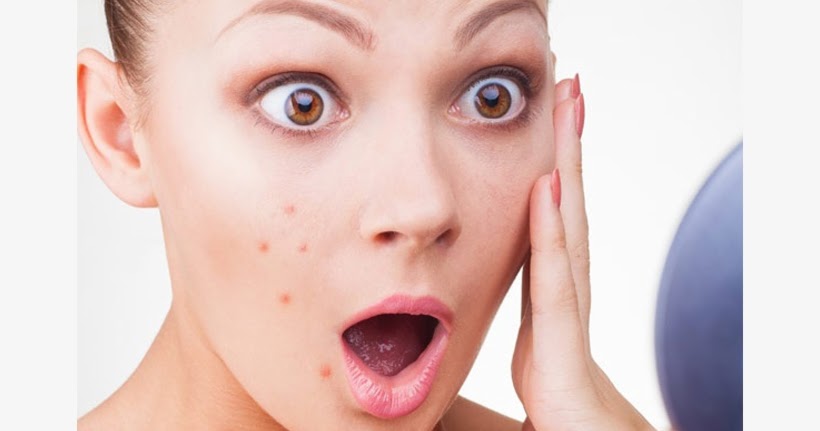 Acne in your 20s or 30s?