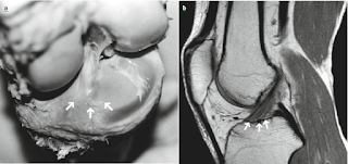 MRI Dây Chằng Chéo Trước (ACL)