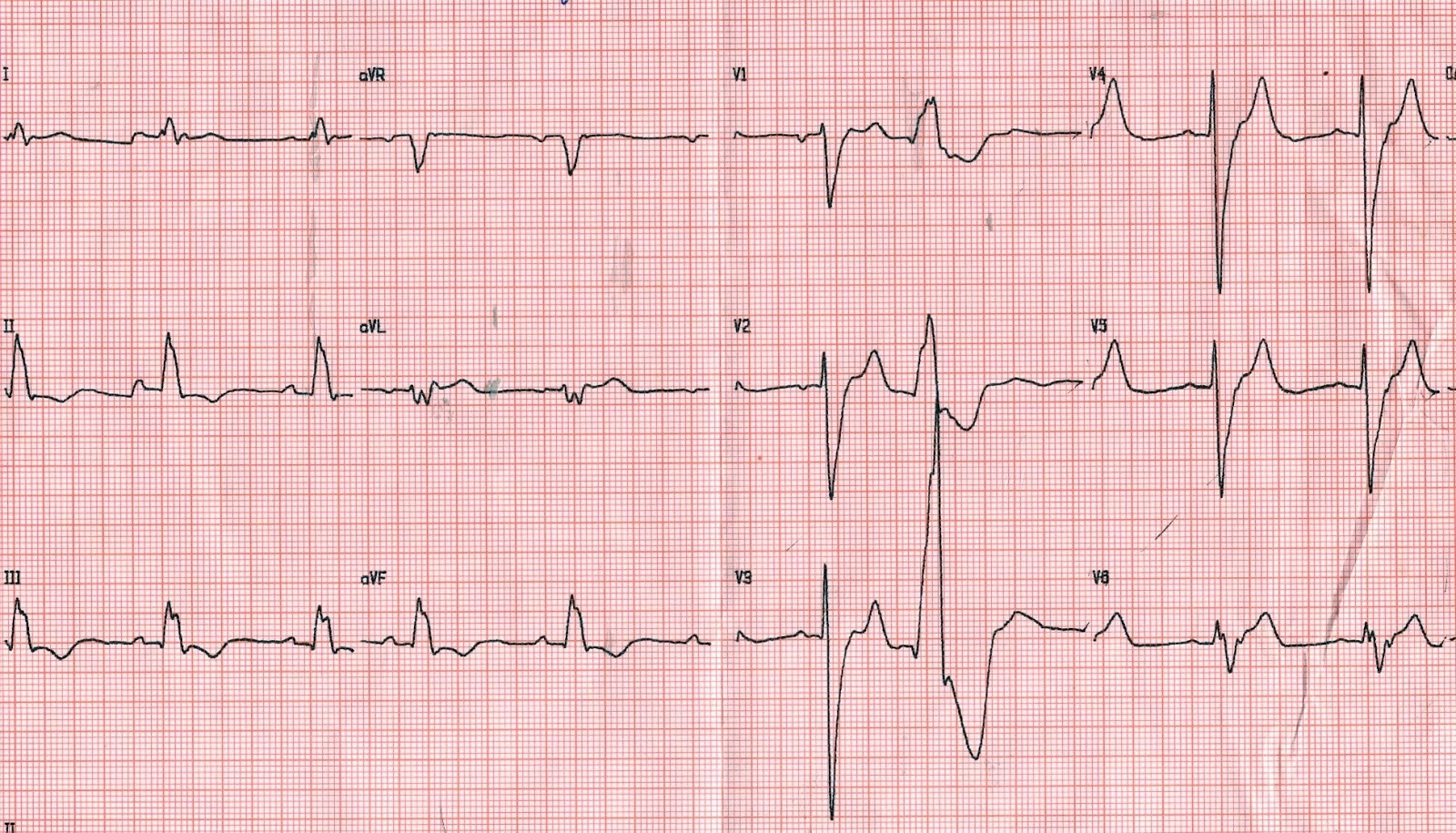 Blog de Eletrocardiografia