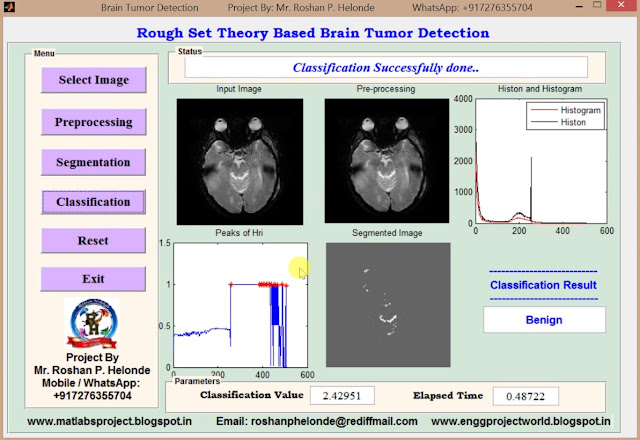 Brain Tumor Detection using Rough Set Theory Algorithm Matlab Project with Source Code ...