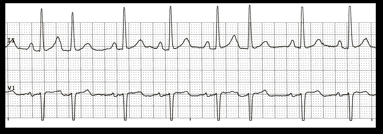 Various Rhythms with PACs