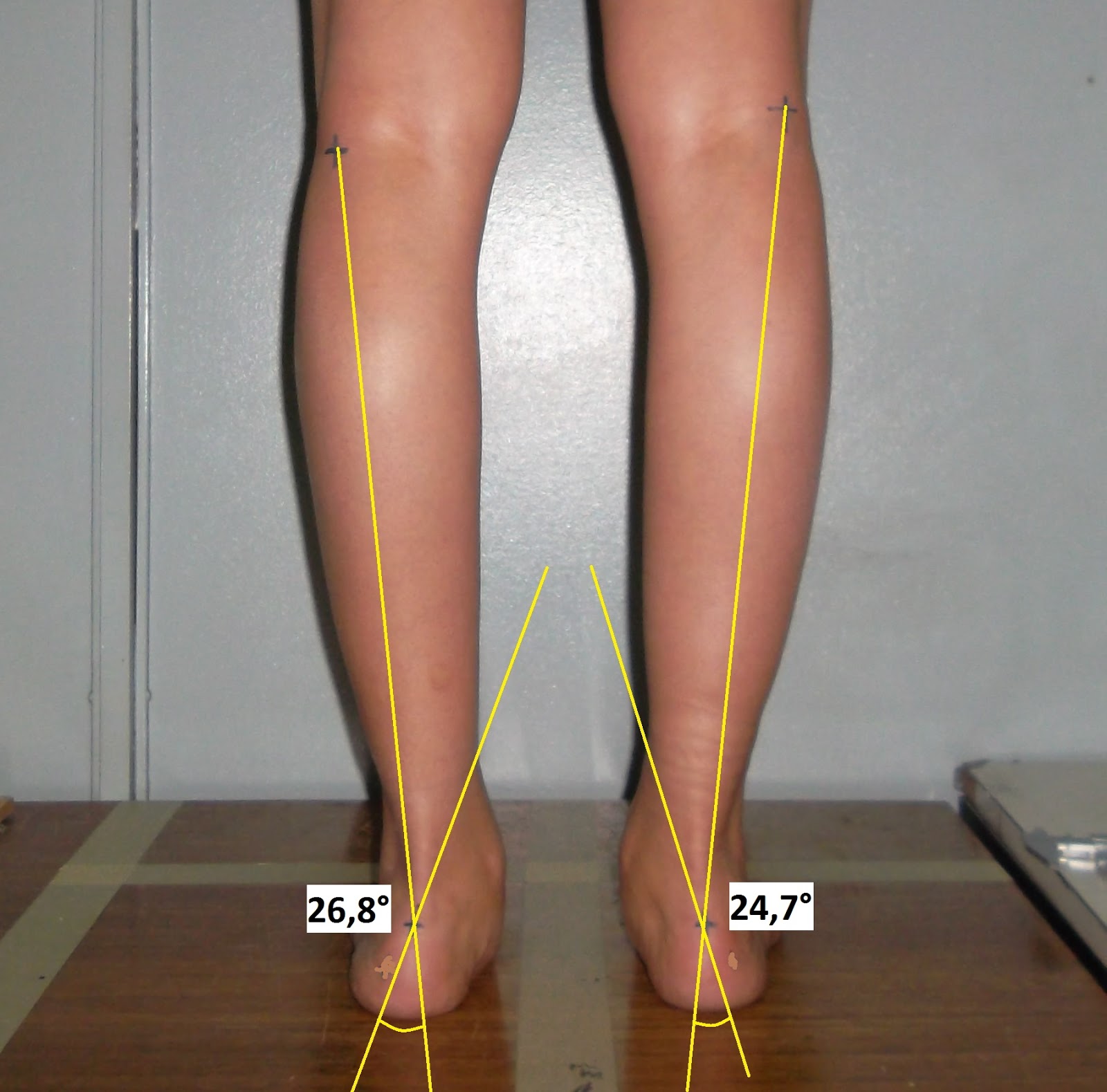 LA CIENCIA DEL CORRER: EL SÍNDROME DE ESTRÉS MEDIO TIBIAL O PERIOSTITIS ...