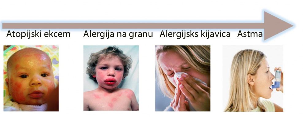Šta je alergija?
