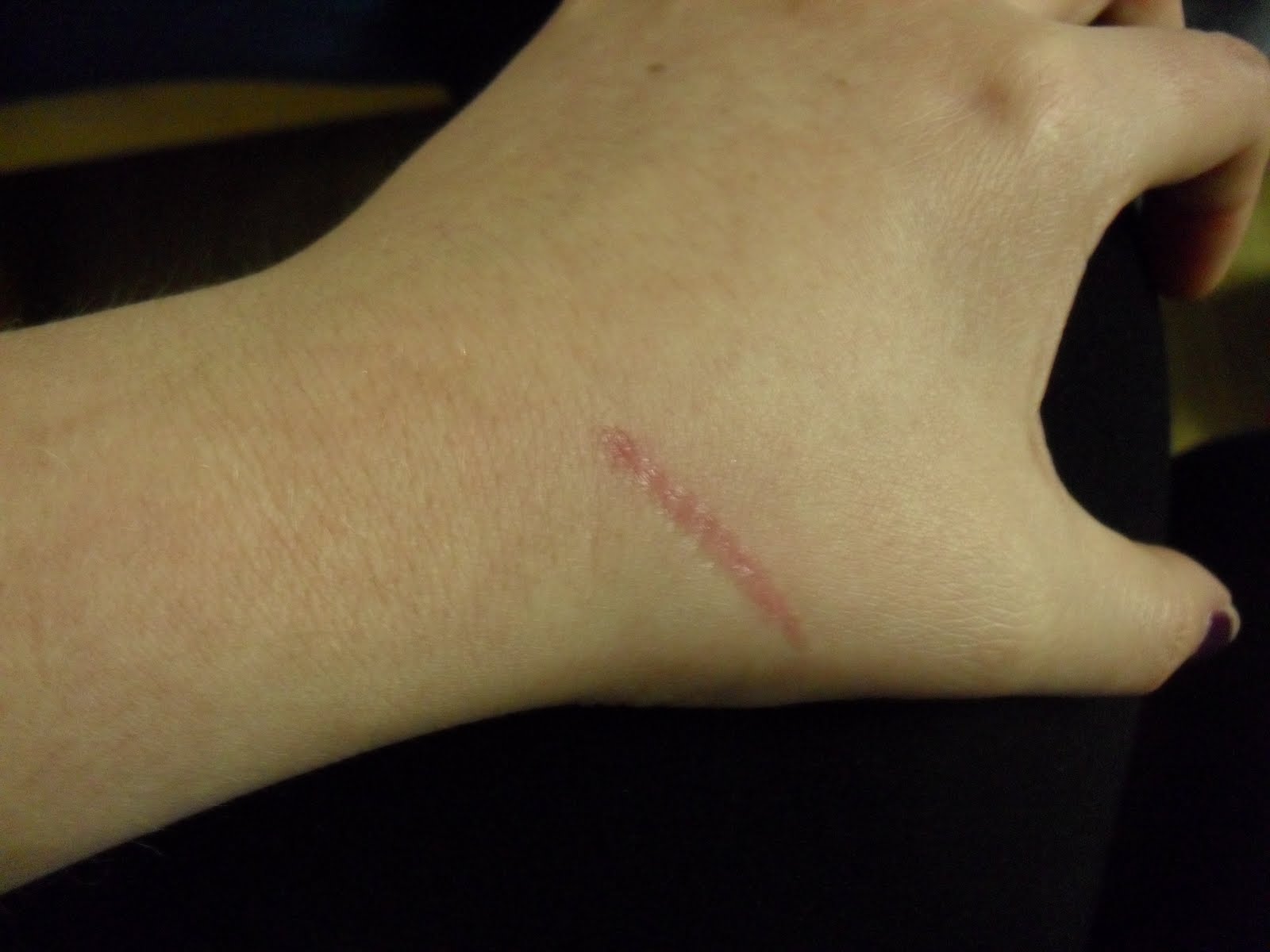 Jessica Elizabeth Guthrie: Burns, Scars, Cuts & Extremes in Weather.