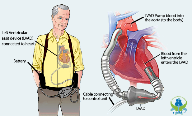 Left Ventricular Assist Device (LVAD)