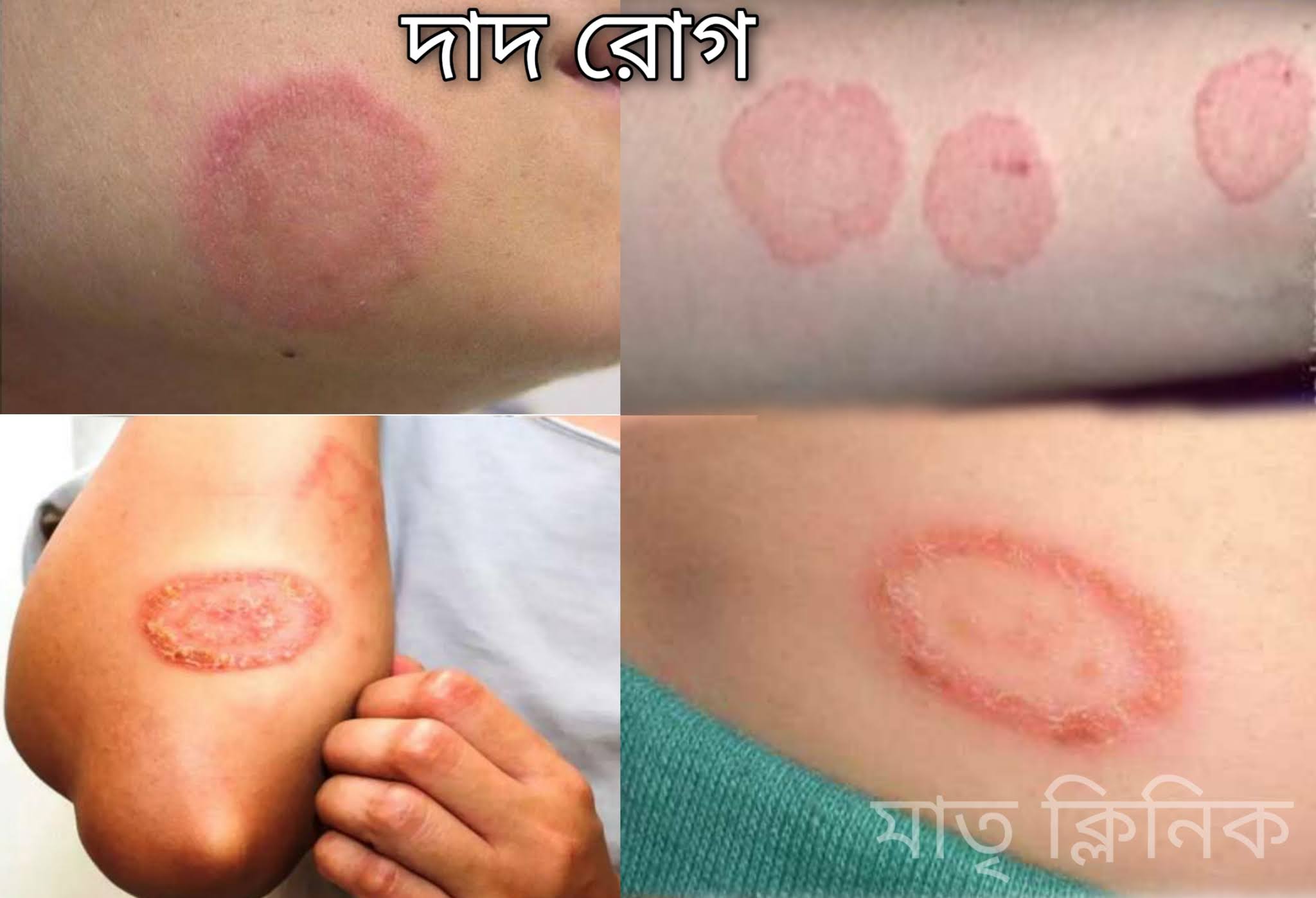 দাদ রোগ (Ringworm or Tinea)