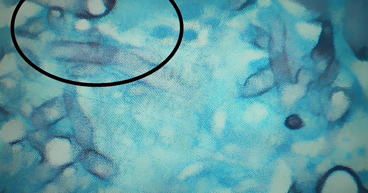 Mucormycosis simplified notes.