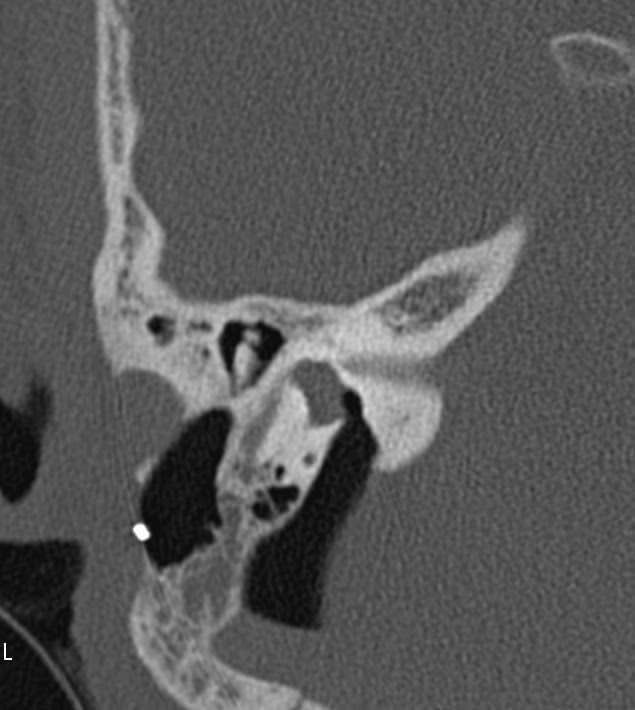 Cochlear implants and the Radiologist - Radiology Imaging