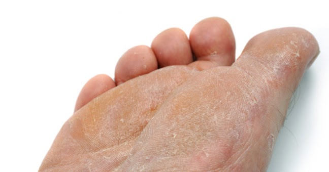 5 Remédios Caseiros para Pé de Atleta (Tinea Pedis) - Como Cuidar dos Pés