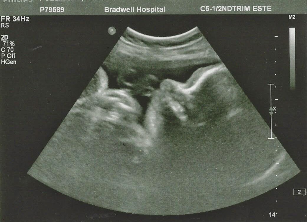 Podheim: 31 Week Scan