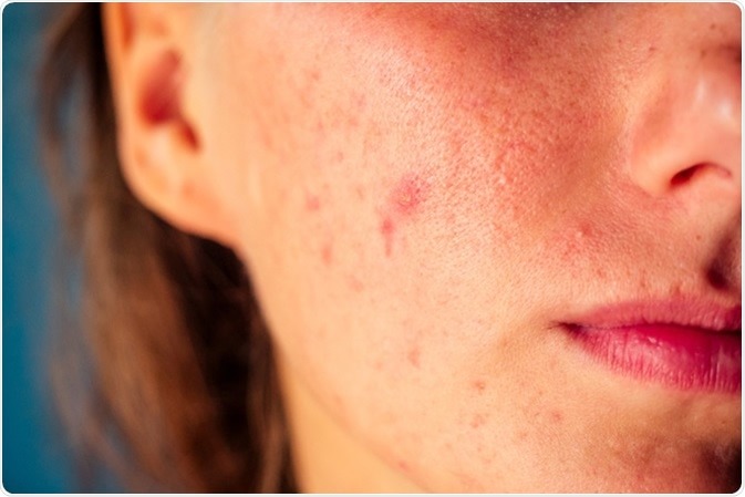 Acne Treatment Blog How To Hide Red Tones From Acne Rosacea And Sensitive Skin Acne Treatment Blog How To Hide Red Tones From Acne Rosacea And Sensitive Skin