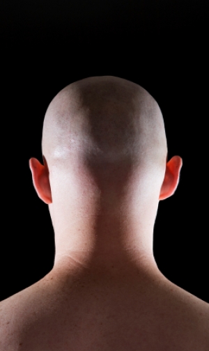 Un chauve peut-il avoir des pellicules? ~ Général Kulture!