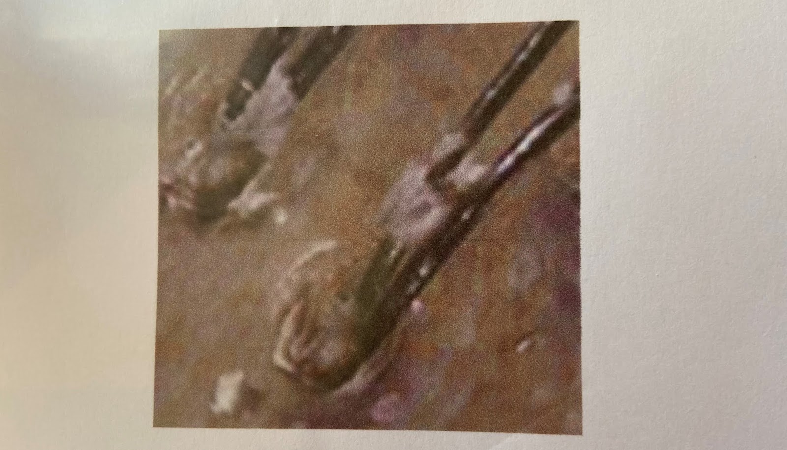 Clogged Hair follicle | Hair Growth Clinic