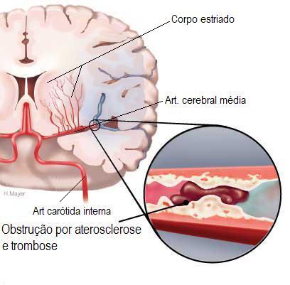 X-RAYview: AVC - Acidente Vascular Cerebral
