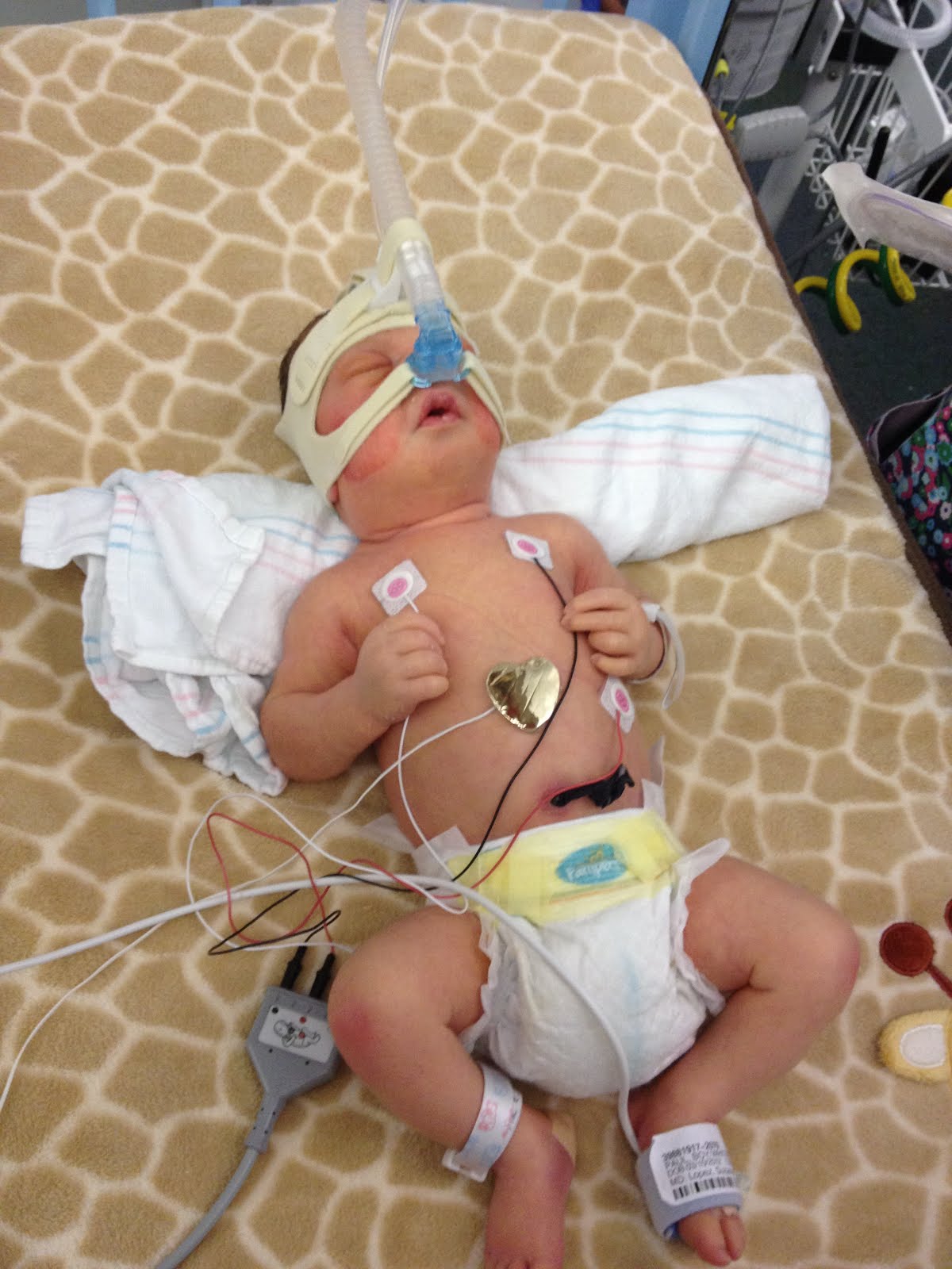 Our Journey: Self Extubation (3/24)