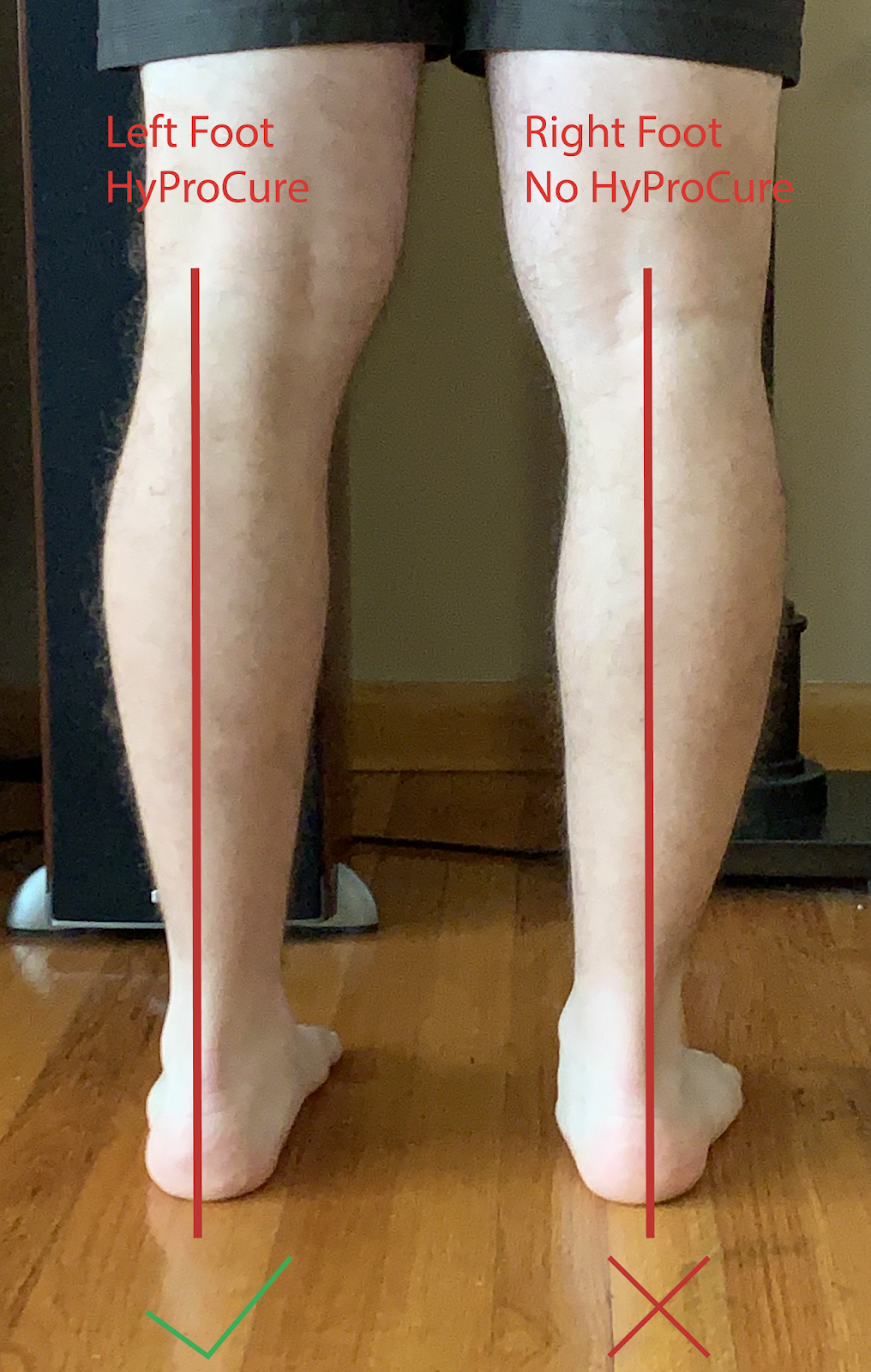 HyProCure Post Surgery Results with Photos and Comparisons