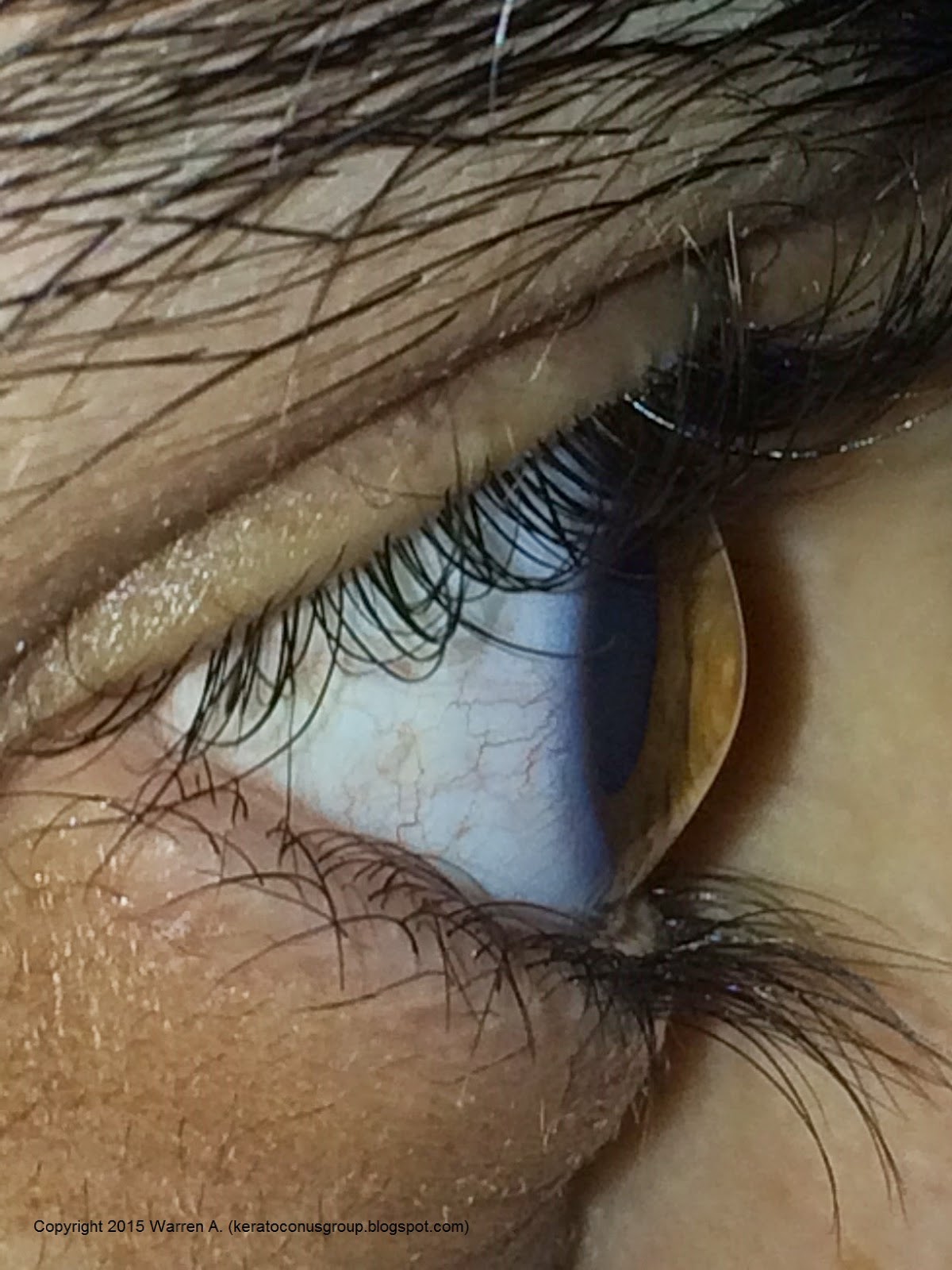 Photos of the Cornea in a Patient with Keratoconus | Keratoconus Group