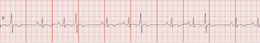 EKG Rhythm Strips 81: Bigeminy, Trigeminy, Quadrigeminy...
