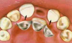 be pro dentist: Resin Bonded Bridges