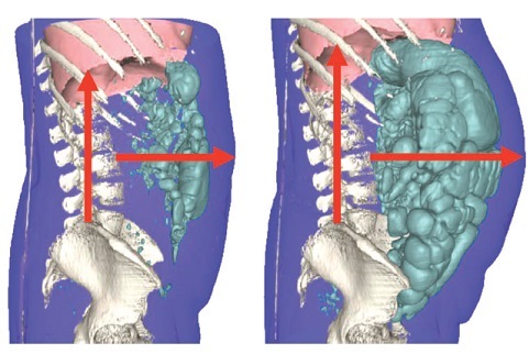 EmergenMed Health Blog: Hinchazón y distensión abdominal