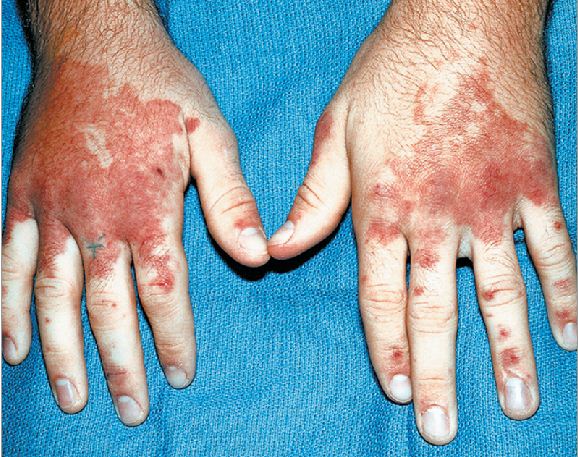 Diagnose: Endocarditis Diagnose