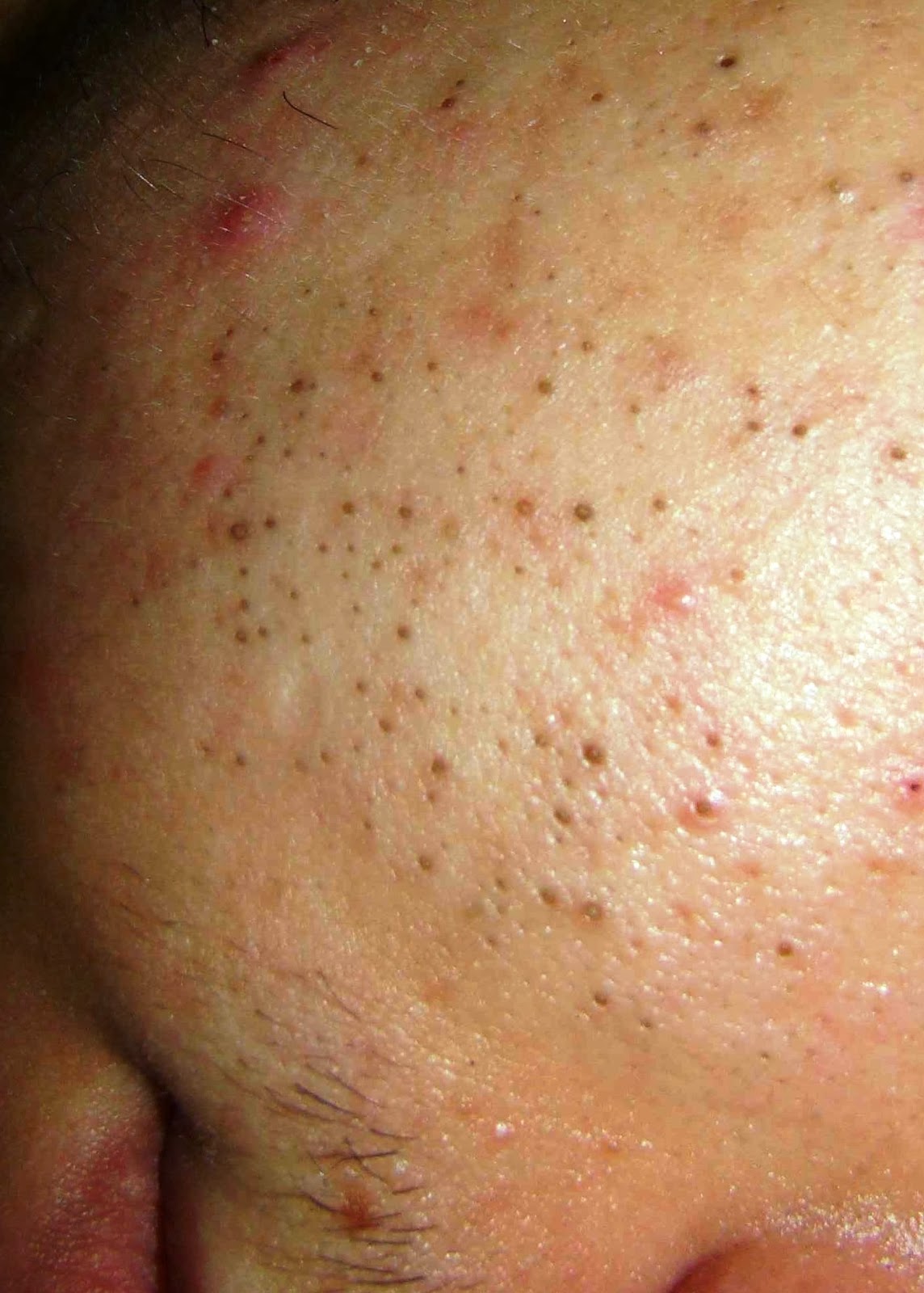 Tips on getting rid of blackheads