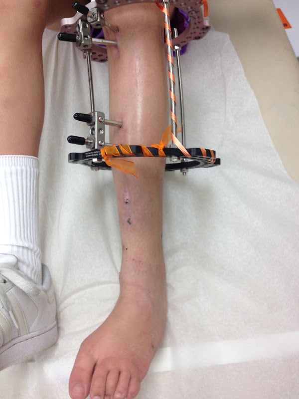 fibular hemimelia leg lengthening: Officially scheduling fixator removal