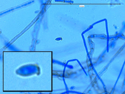 Fun With Microbiology (What's Buggin' You?): Fonsecaea pedrosoi/monophora