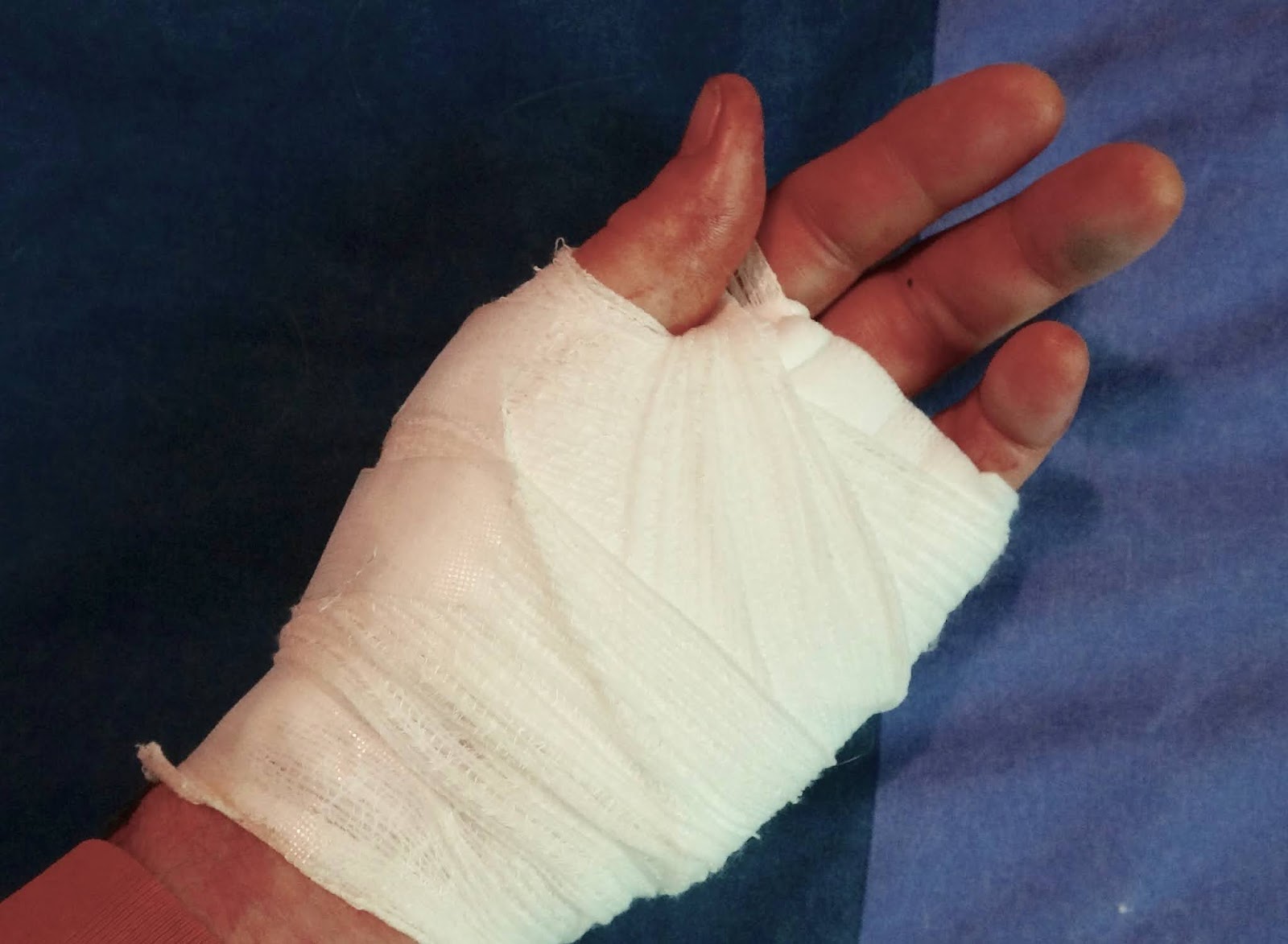 NewBlog: The Freak Accident That Cost Me A Finger