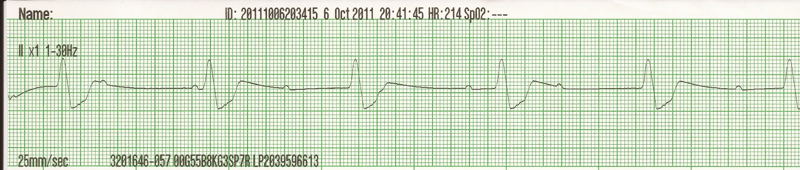 ACLS Rhythms: Heart blocks