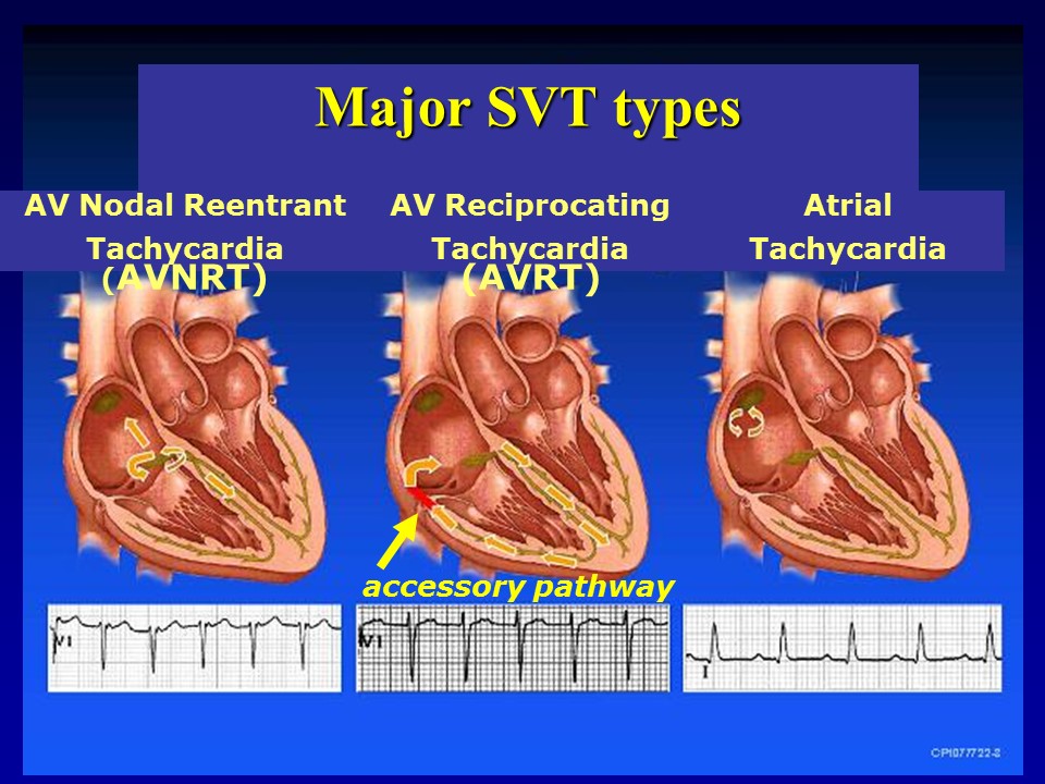 CVT Mohd Farid: Electrocardiogram Arrhythmia Part II-Credit Dr ...