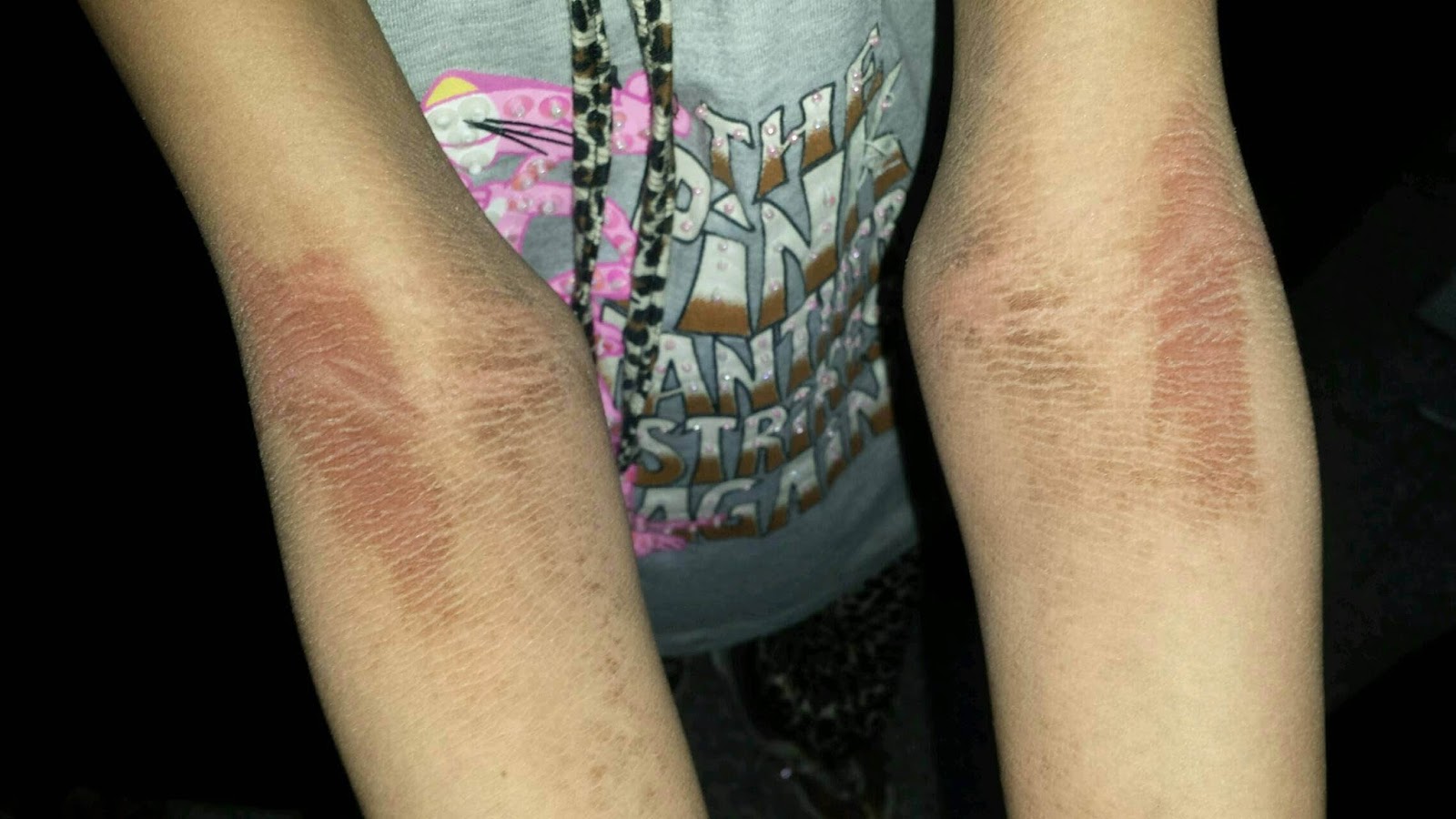 VIRTUAL GRAND ROUNDS IN DERMATOLOGY 2.0: Tay Syndrome (Trichothiodystrophy)