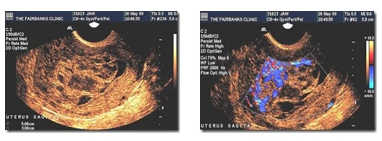 Materi Kebidanan: MOLA HIDATIDOSA