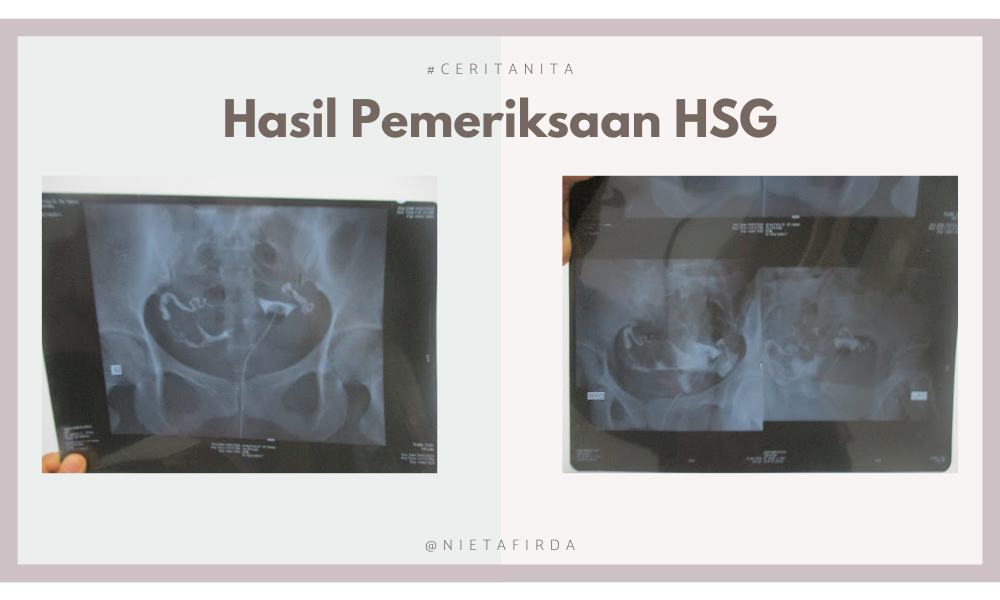 Sharing Pengalaman Melakukan HSG di Hi-Lab Yogyakarta 2018 — nieta firda