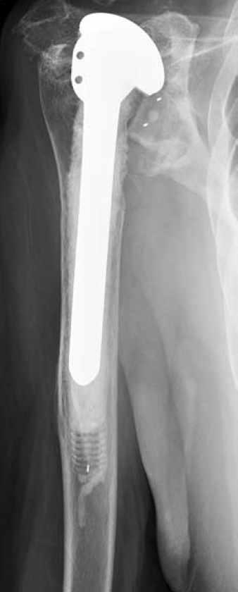 UW Shoulder and Elbow Academy: The importance of the humeral osteotomy ...