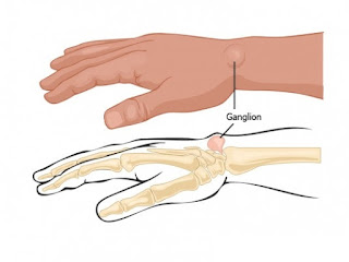 Cara Mengobati Ganglion Pada Pergelangan Tangan Tanpa Operasi ...