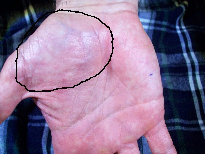 Gye Greene's Thoughts: Bruised hand