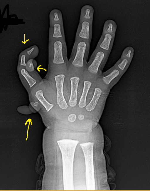 Unusual Pre-axial Polydactyly - Sumer's Radiology Blog