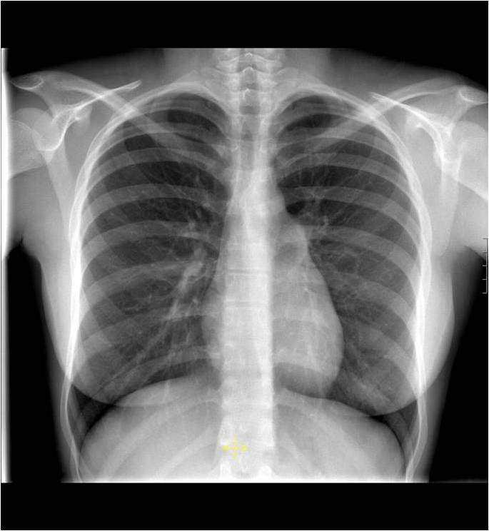 ¿Sabemos leer una RX de tórax? Parte 1: Recuerdo anatómico ...