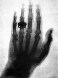 HISTORY: History of X-Ray