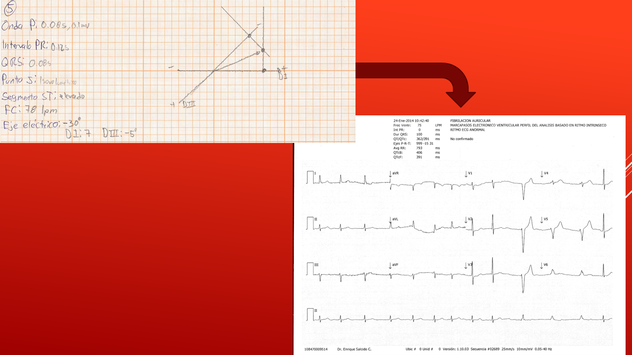 Fisiología Básica: Electrocardiograma - Interpretación y Eje eléctrico