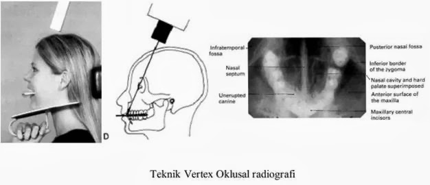 Teknik Radiografi Dental ~ Dent-ias || notes