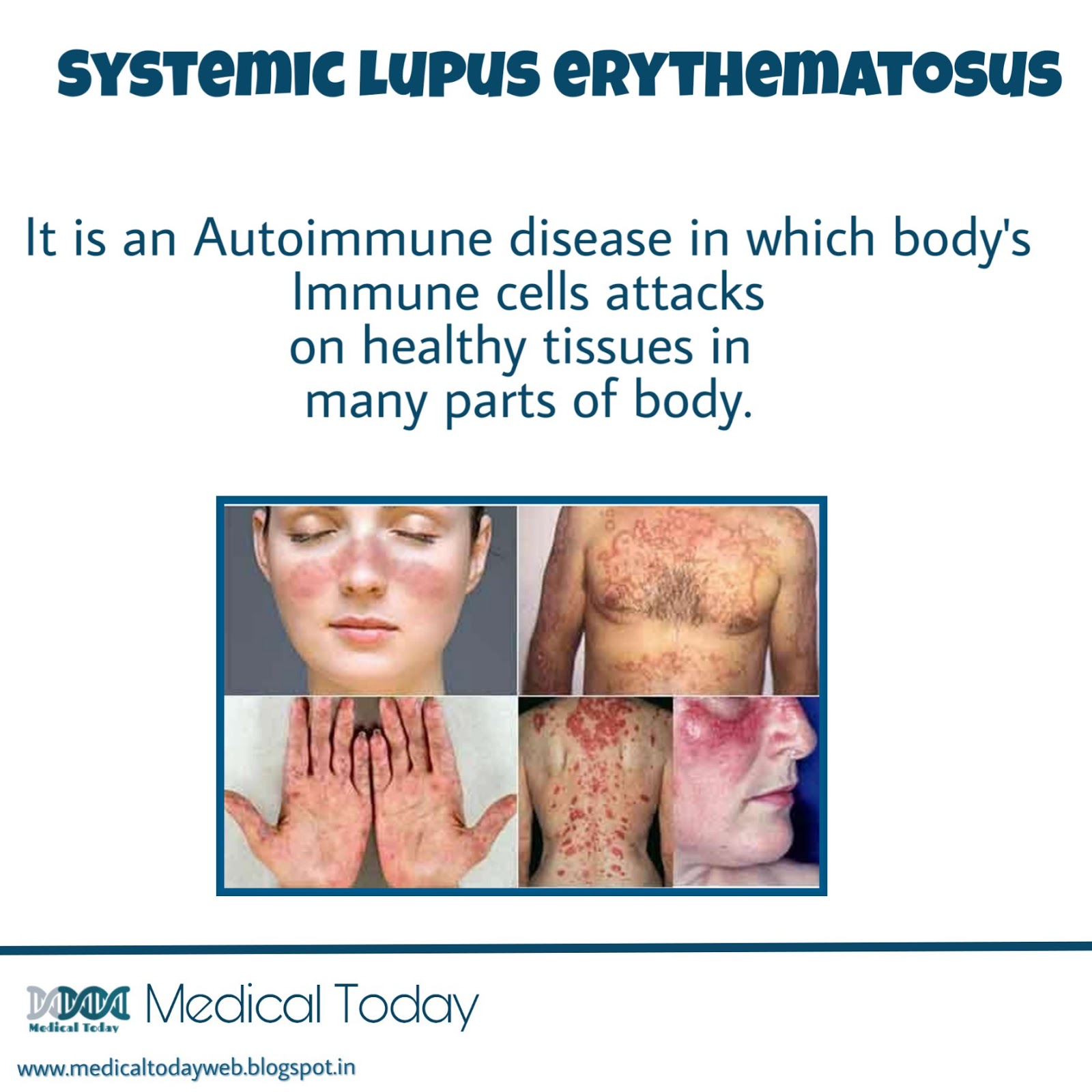 Medical Today Systemic Lupus Erythematosus SLE 