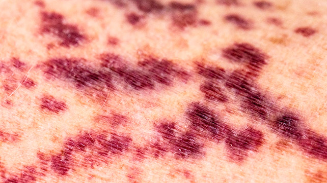 Recognize and Treat an Anemia Rash[हिन्दी]