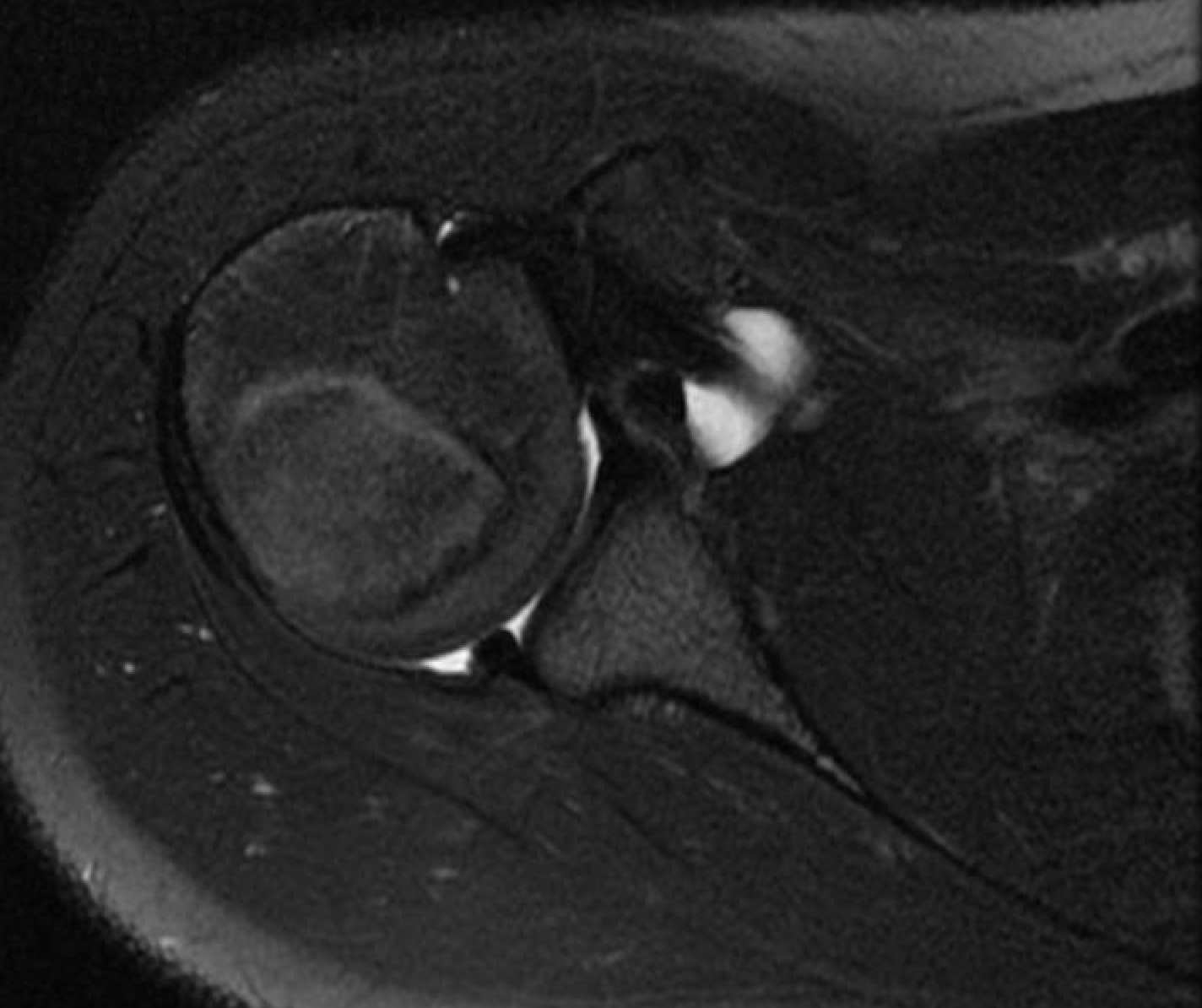 Shoulder and Elbow Surgery: Posterior chondrolabral cleft and recurrent ...