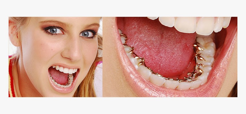 Affordable Orthodontic Treatments Chennai Lingual Orthodontics