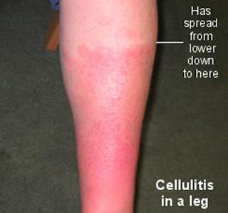 Nursing Care Plan: Nursing Diagnosis for Cellulitis