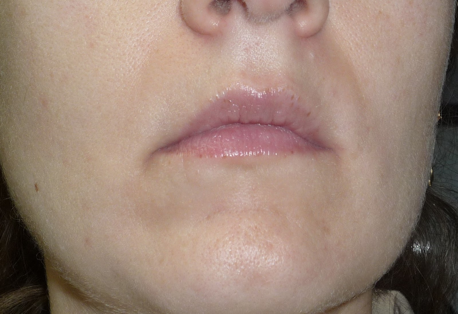 Sew Many Things: Seborrheic Dermatitis, Skin, and updates